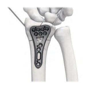 Placas Palmares – Orto Spine