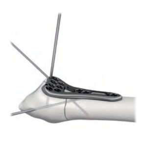 Placas Palmares – Orto Spine