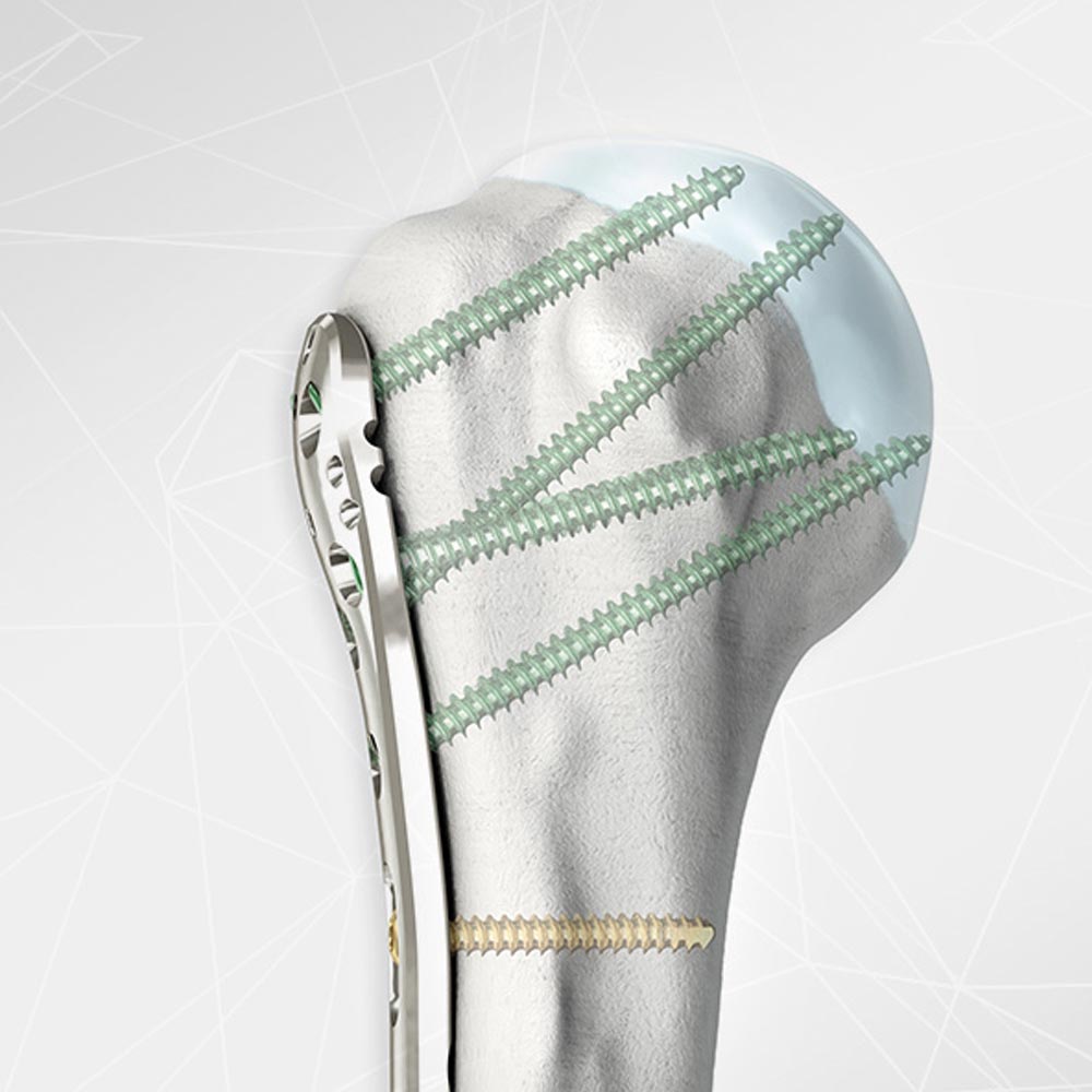 Placa Humero Proximal PHILOS – Orto Spine